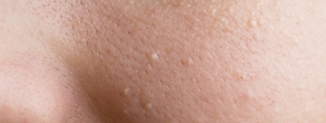 Quistes de milium. Qué son, causas y cómo prevenirlos