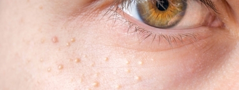 Quistes de milium. Qué son, causas y cómo prevenirlos